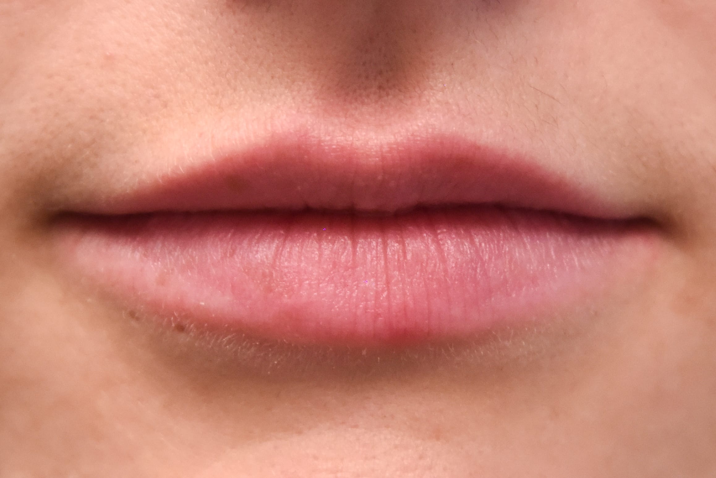 Lip Filler-2 - Ottawa Laser ClinicOttawa Laser Clinic